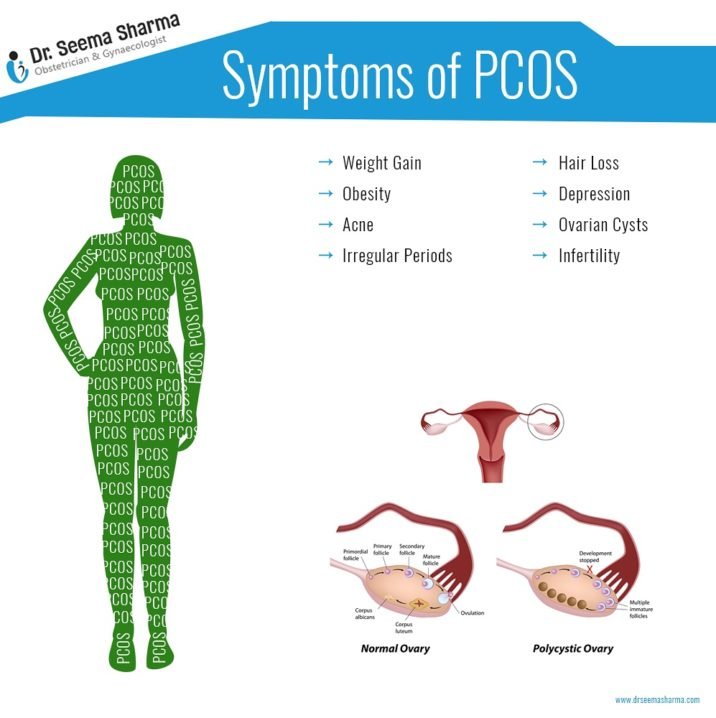 Symptoms of PCOS | Dr. Seema Sharma